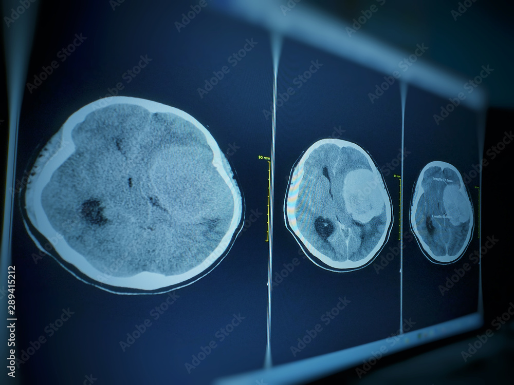 CT Brain Seven cm. diameter hyperdensity mass with lobulated surface at ...