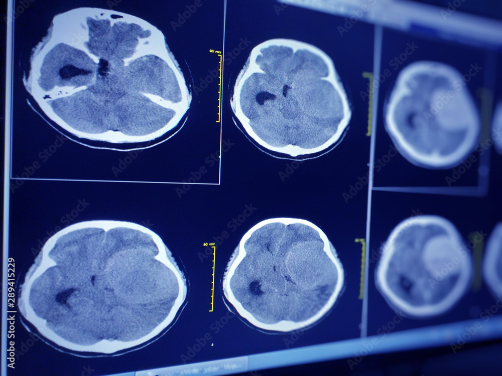 CT Brain Seven cm. diameter hyperdensity mass with lobulated surface at ...