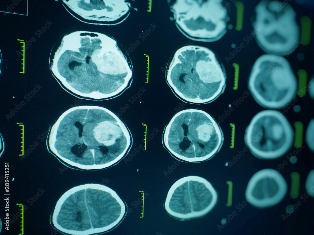 CT Brain Seven cm. diameter hyperdensity mass with lobulated surface at ...