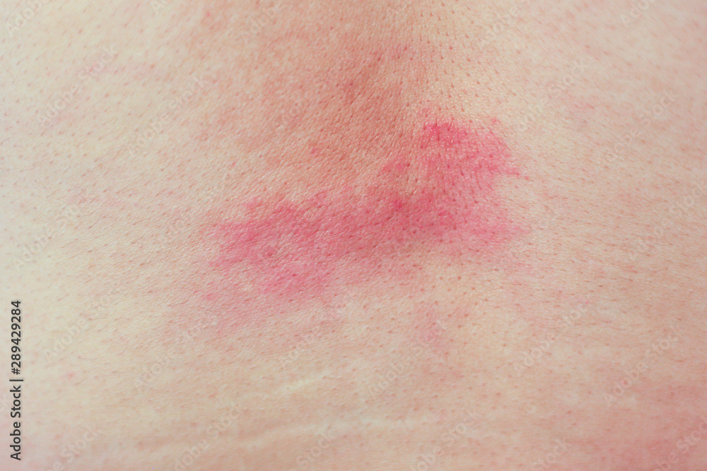 Adult male body skin irritation and allergy, Atopic Dermatitis or ...