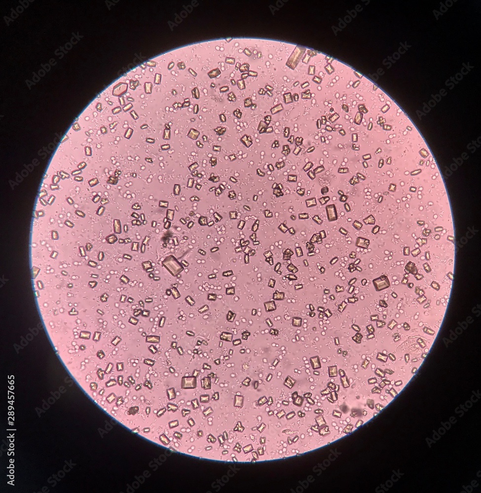 Urine analysis finding with microscope show crystal bacteria and ...