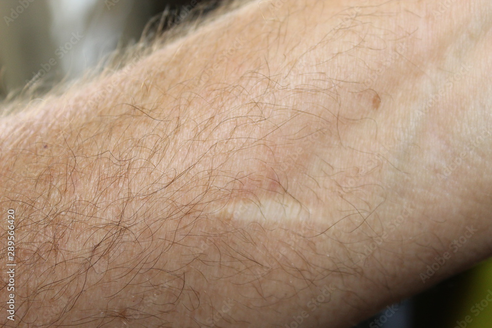 Arm Scar Stock Photo | Adobe Stock
