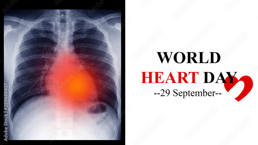 Film X ray(CXR) of chest and heart anatomy. Word heart day on 29 ...