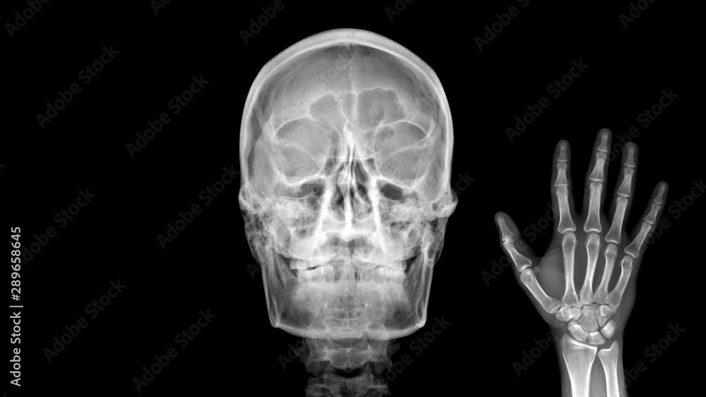 Foto de Film X ray radiograph show human anatomy of skull bone and ...