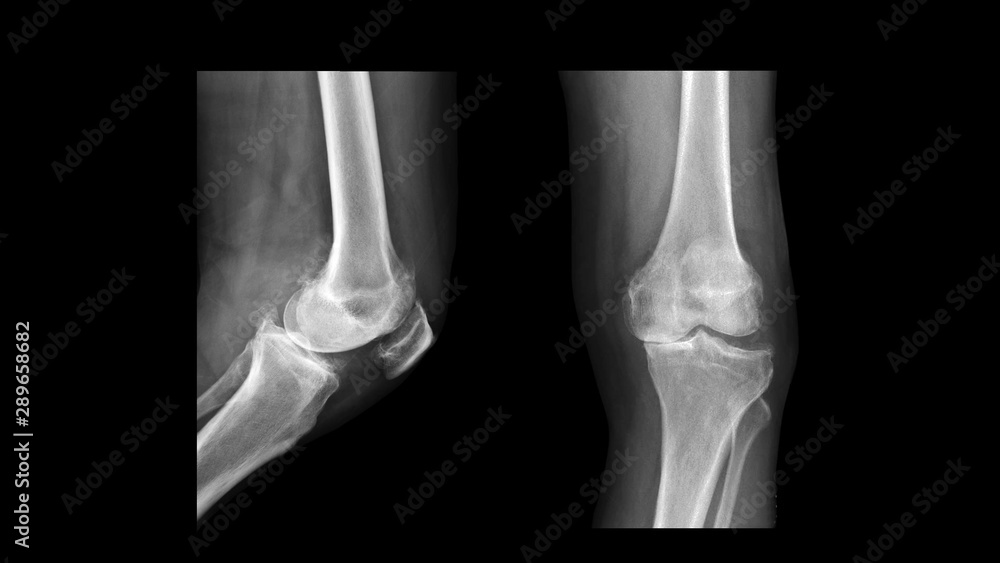 Film X ray knee radiograph show degenerative osteoarthritis disease (OA ...