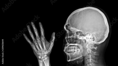 Acromegaly X Ray