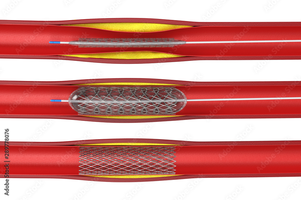 Balloon angioplasty procedure Stock Illustration | Adobe Stock