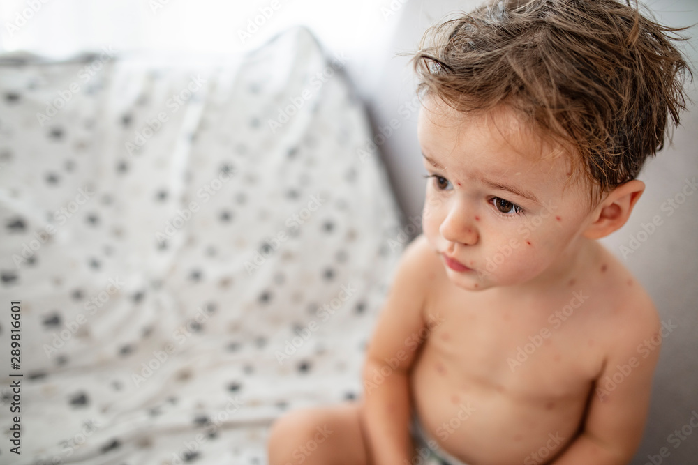 Child with spotted skin. Medical concept. Baby boy with mid-stage ...