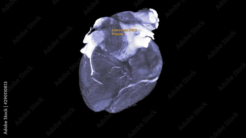 Vidéo Stock CTA Coronary artery 3D rendering image or coronary tree ...