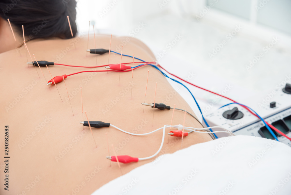 Asian woman receiving acupuncture with electrical stimulator at back ...