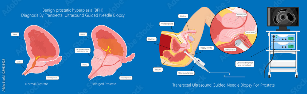 Transurethral resection of the prostate stricture urine bladder digital ...