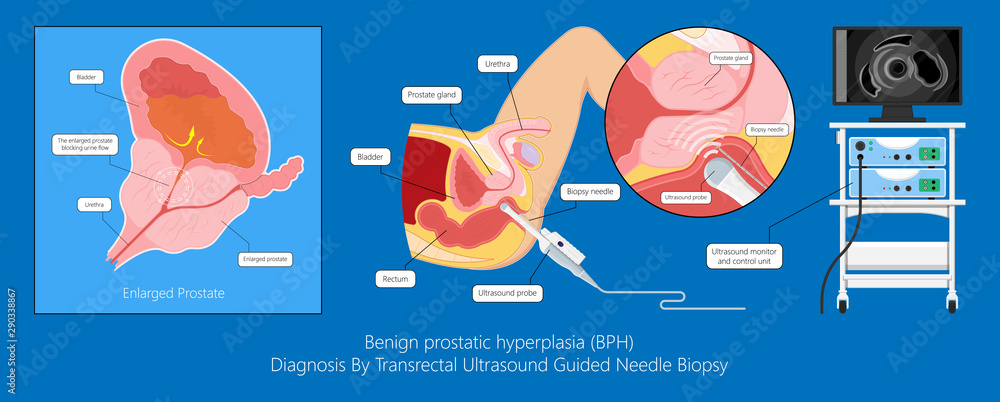 Vettoriale Stock Transurethral resection of the prostate stricture ...