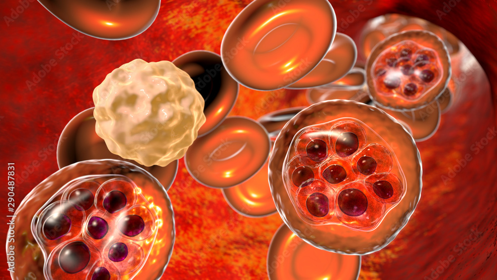 Malaria infection, 3D illustration. Plasmodium parasites inside red ...