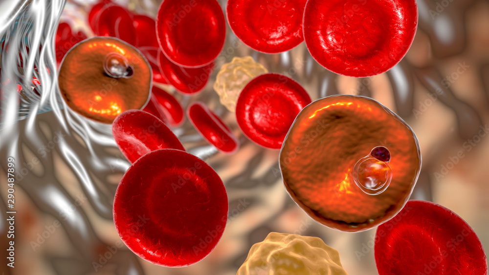 Red blood cells infected with malaria parasite Plasmodium vivax, ring ...