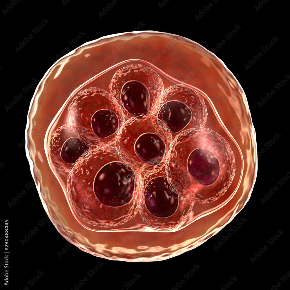 Red blood cell infected with malaria parasite, 3D illustration showing ...