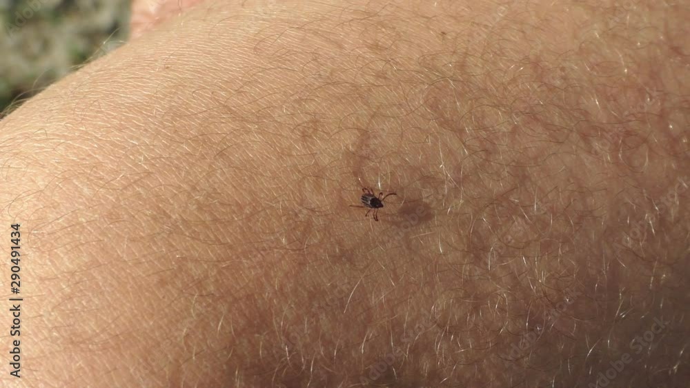 Insect parasite mite crawls on a man's leg. Tick on the skin. vídeo do ...