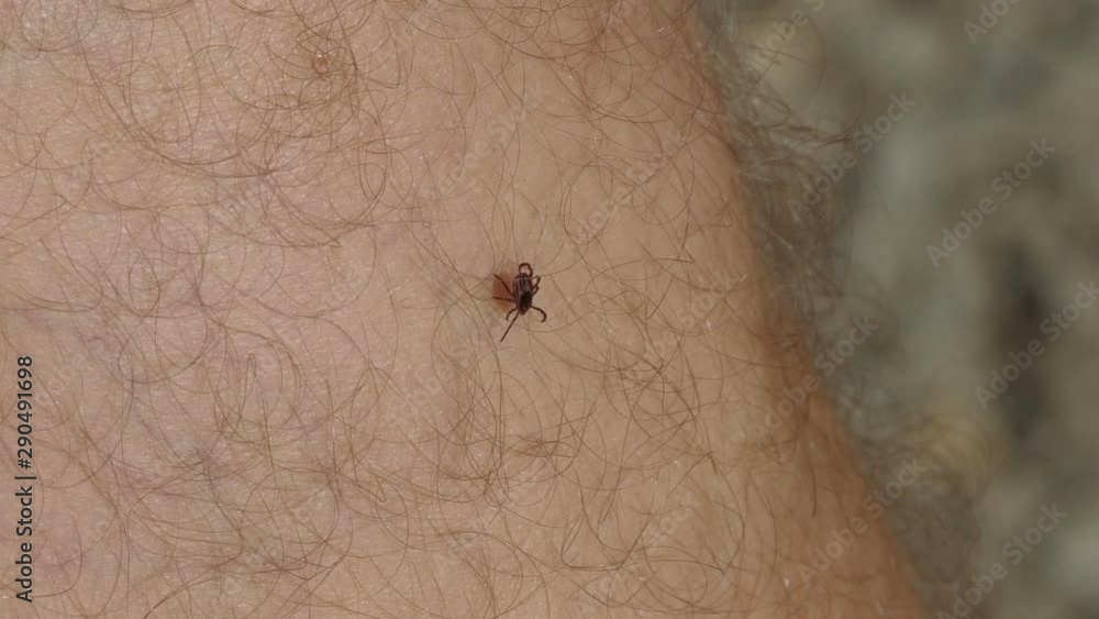 Insect parasite mite crawls on a man's leg. Tick on the skin. Stock ...