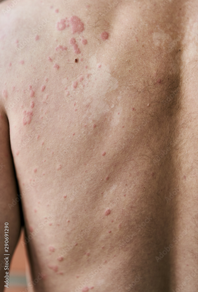 Skin imperfection. Skin allergy. Urticaria disease. Red spots on the ...