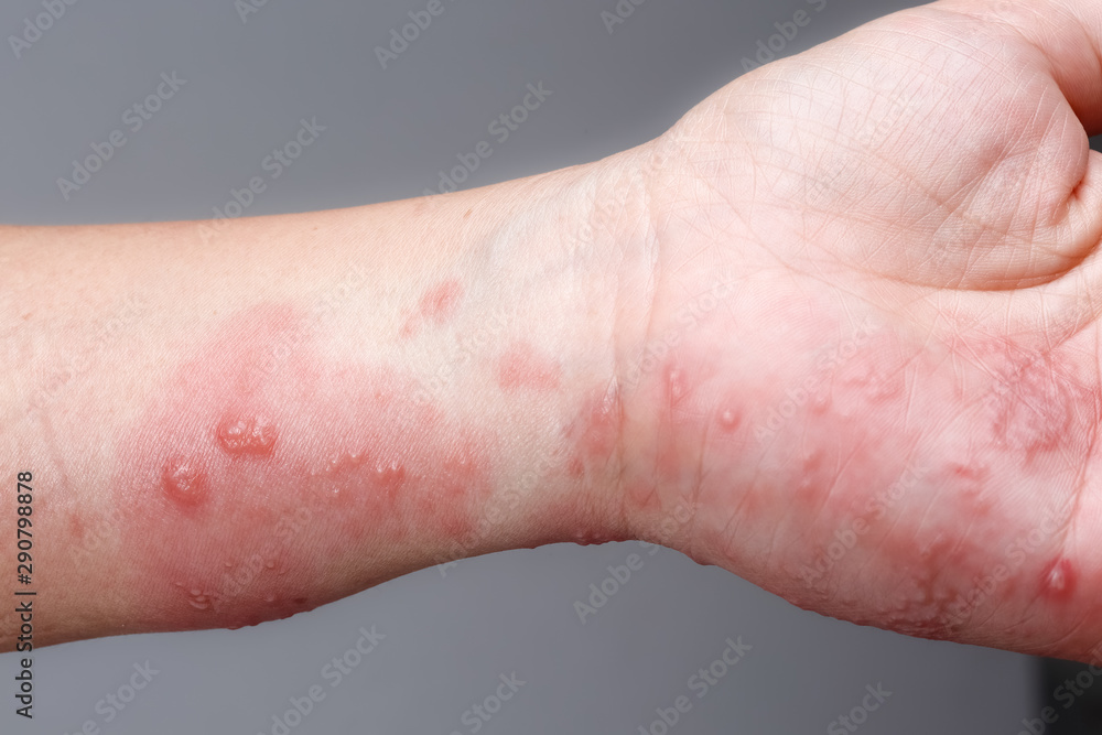 Shingles, Zoster or Herpes Zoster symptoms on arm Stock Photo | Adobe Stock