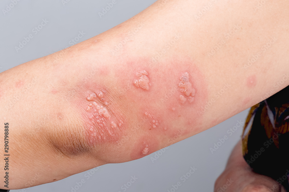 Shingles Zoster Or Herpes Zoster Symptoms On Arm ภาพถ่ายสต็อก Adobe Stock