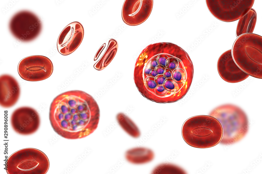 Red blood cells infected with malaria parasite Plasmodium vivax ...