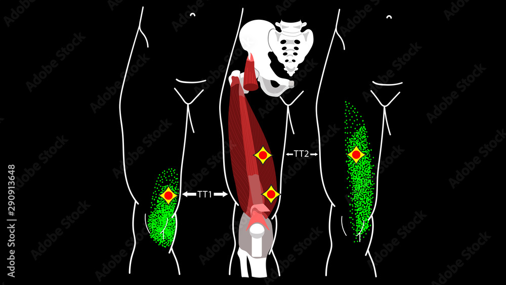 Vastus Medialis Trigger Points. Leg pain. Release Stock Vector | Adobe ...