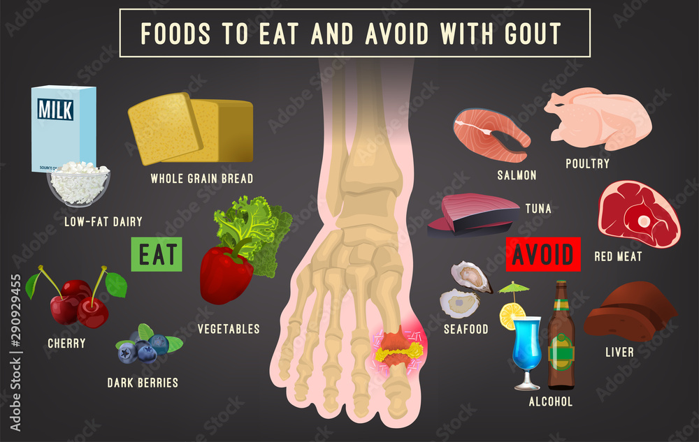 Gout arthritis infographic Stock Vector | Adobe Stock