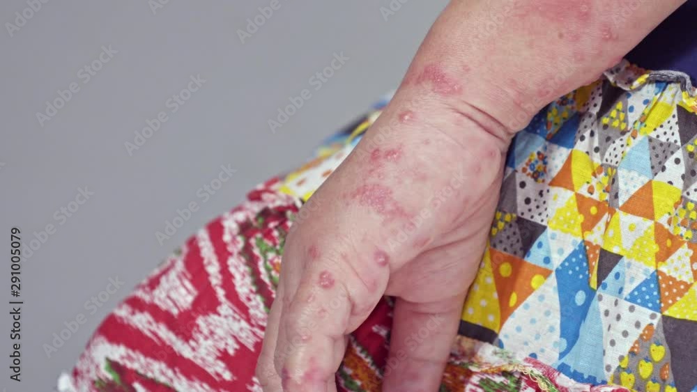 Shingles, Zoster or Herpes Zoster symptoms on arm Stock ビデオ | Adobe Stock