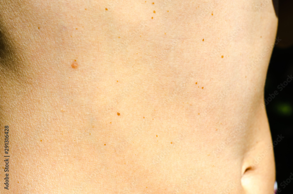 Skin of woman aged 38 years. Woman after giving birth. Signs and small ...