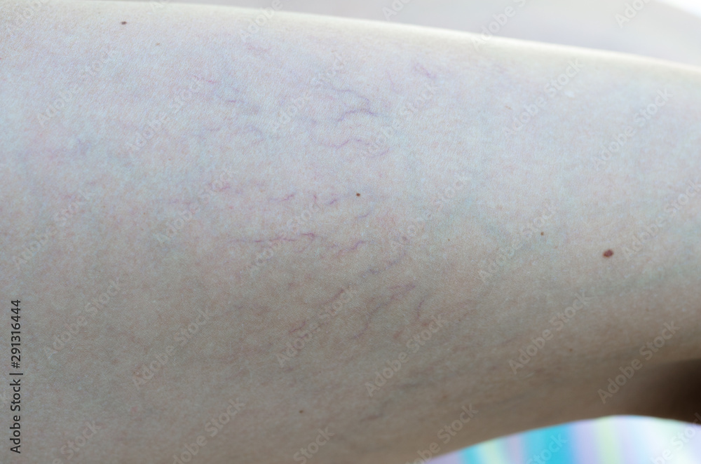 Broken veins form when small veins just under the skin become swollen ...