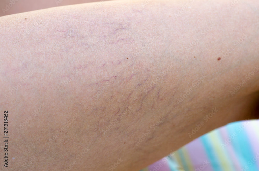 Broken veins form when small veins just under the skin become swollen ...