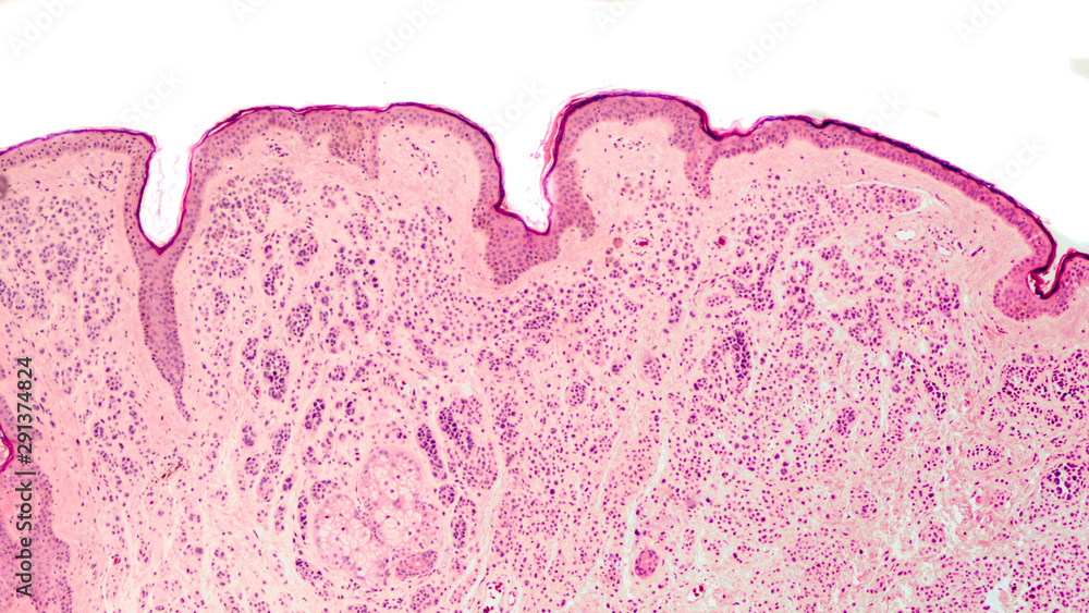 Photomicrograph of a skin biopsy showing an intradermal nevus, a tumor ...