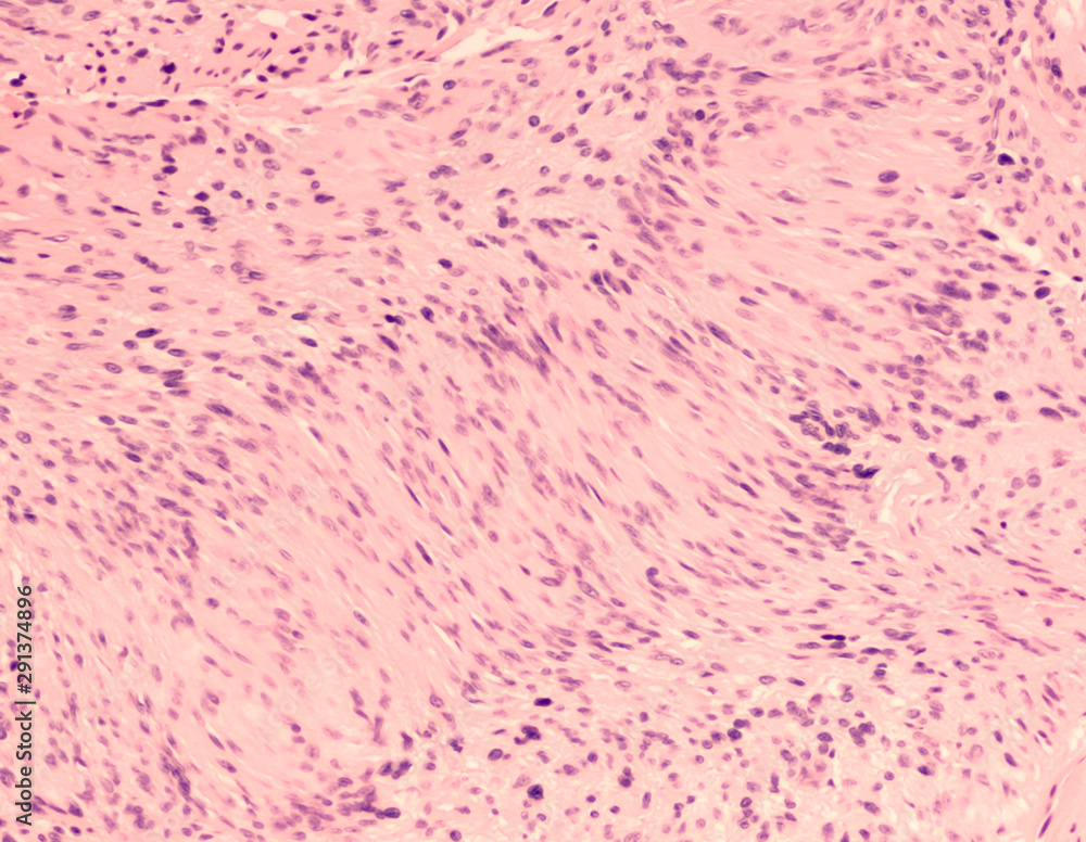 Photomicrograph of a schwannoma, a benign soft tissue tumor of ...
