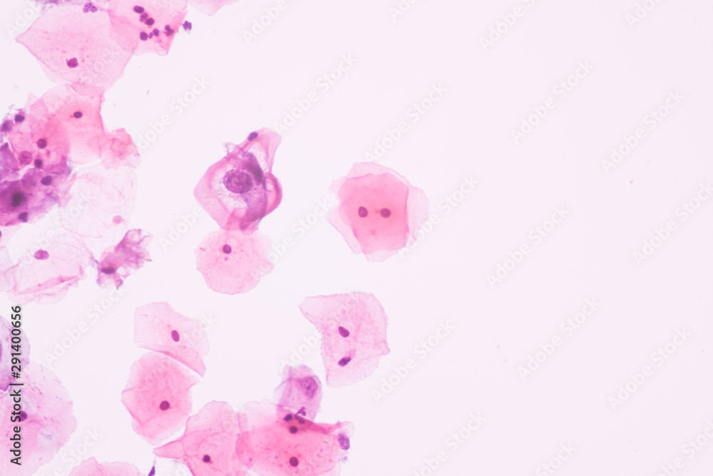 View in microscopic of abnormal human cervix cells.Koilocyte cell ...
