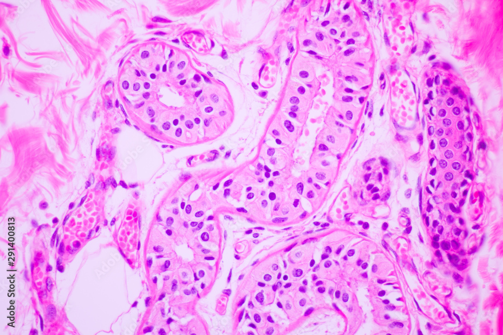 Section tissue of breast cancer view in microscopy.Ductal cell ...