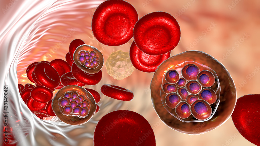 The malaria-infected red blood cells. 3D illustration showing malaria ...