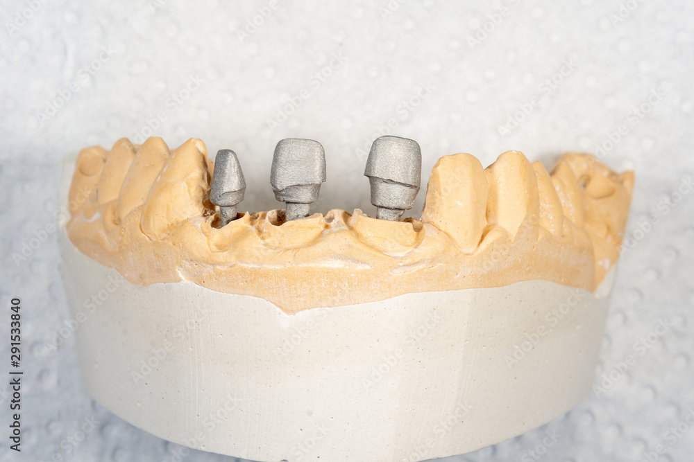 metal cast pin of a human tooth on a gypsum model close-up in a dental ...