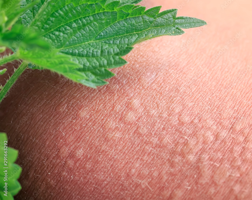 plant stinging nettle lying on irritated human skin covered with small ...