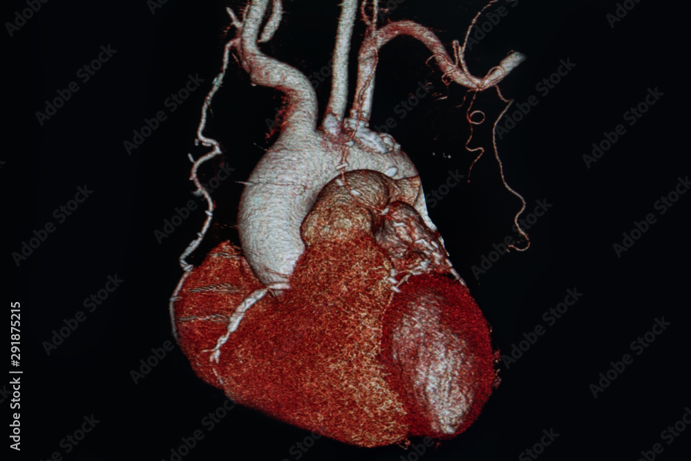 X-ray medical scan heart in hospital. CTA, CT angiography 3D rendering ...
