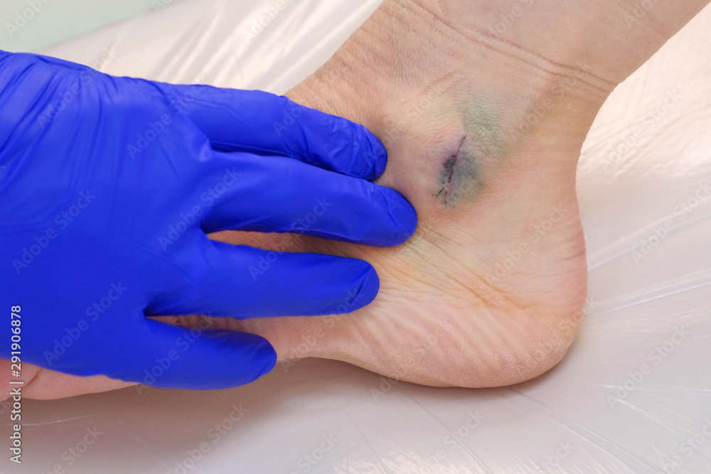 Surgeon palpates leg around suture after surgery to remove ankle ...