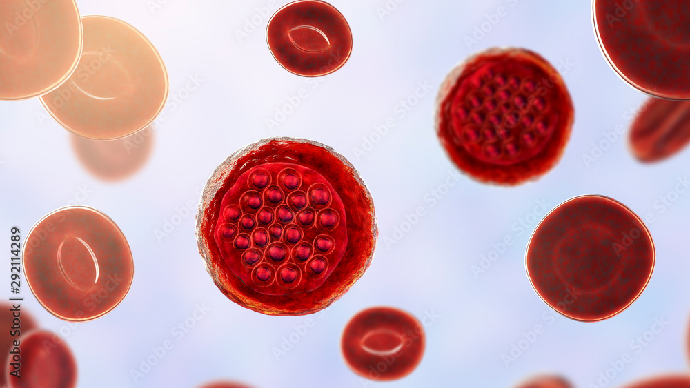 The malaria-infected red blood cells. 3D illustration showing malaria ...