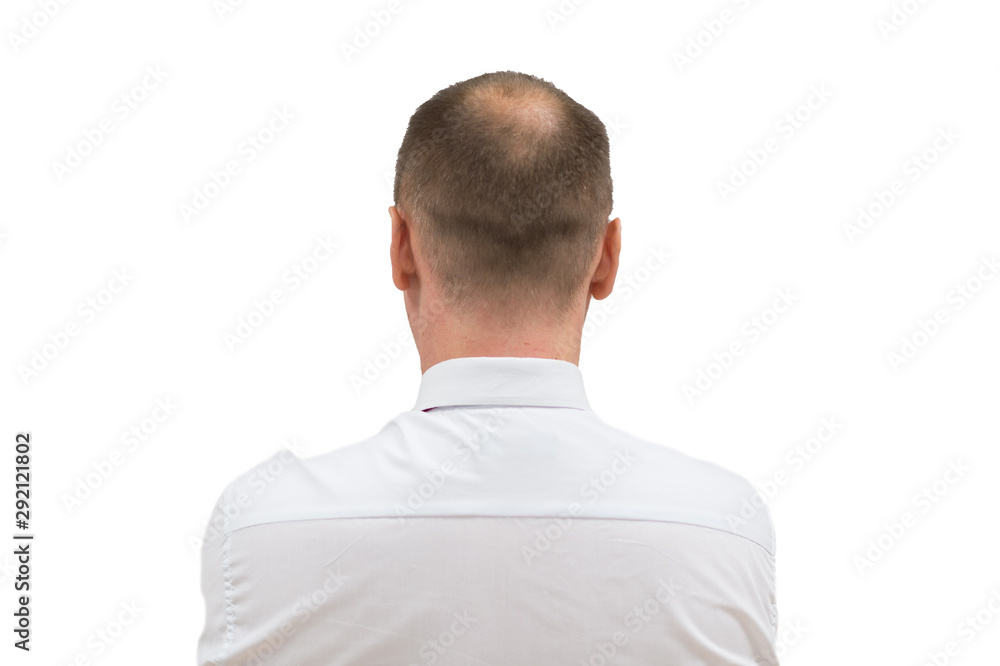 Human alopecia or hair loss - adult men bald head. back of balding man ...