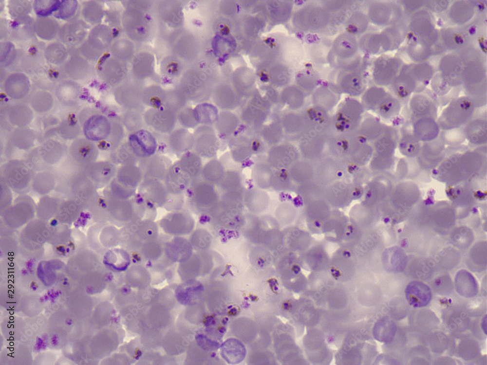 Blood smear of a patient with malaria. Plasmodium falciparum. Stock ...