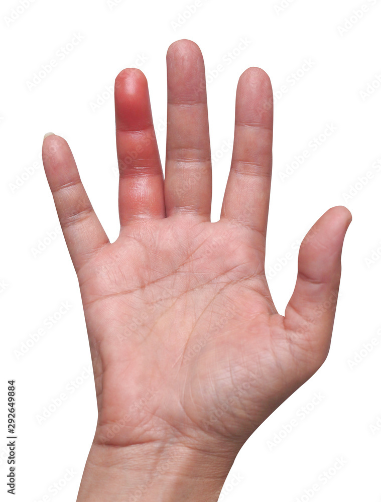 Bee Sting Finger Swelling