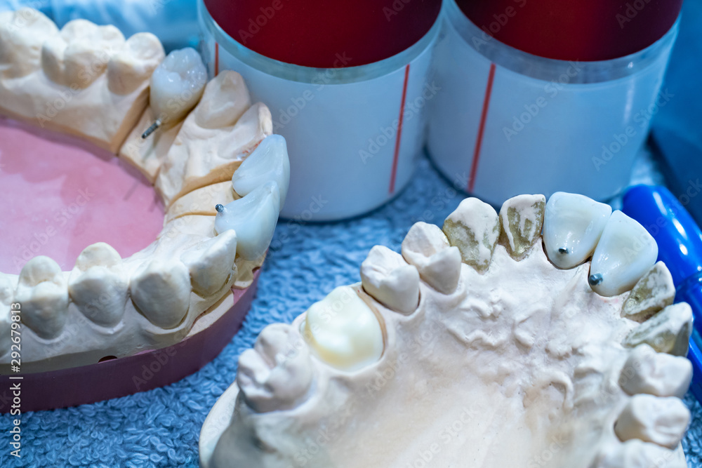 Manufacture of removable prosthesis. The exact model of the jaw. False ...