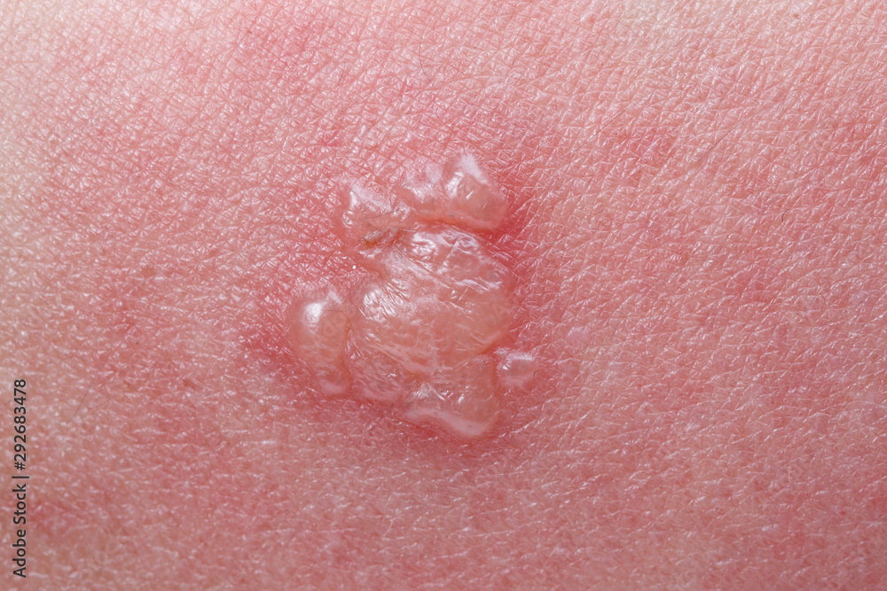 Shingles, Zoster or Herpes Zoster symptoms Stock Photo | Adobe Stock