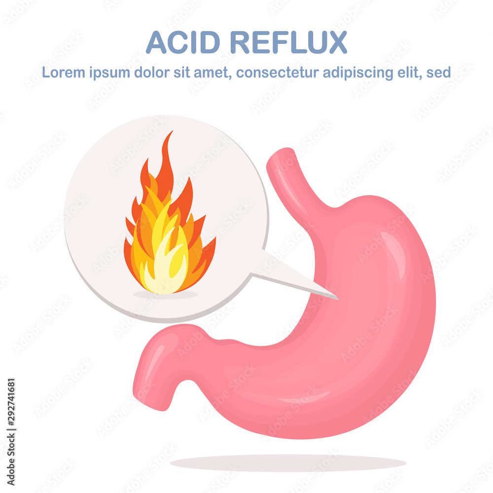 Human stomach. Gastroesophageal reflux disease. GERD, heartburn ...