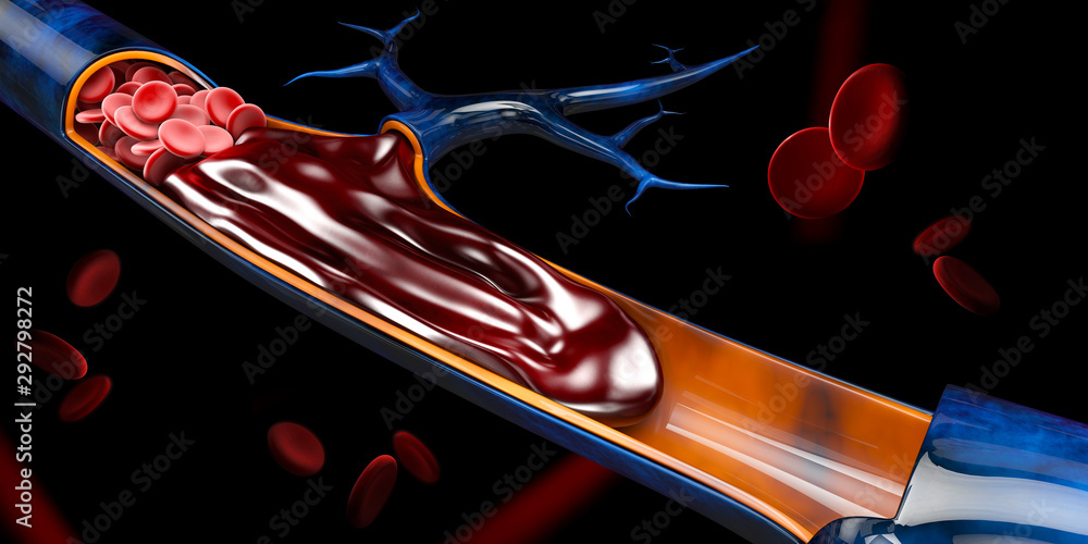3d Illustration of Deep Vein Thrombosis or Blood Clots. Embolism Stock ...