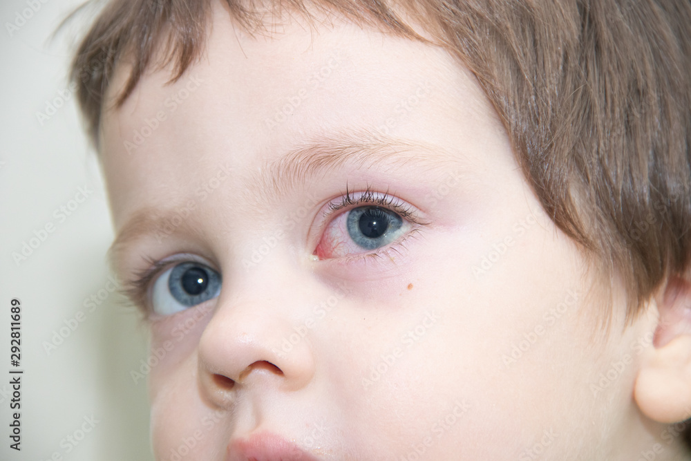 conjunctivitis in the eye of a child. Ophthalmic diseases. Red eye ...