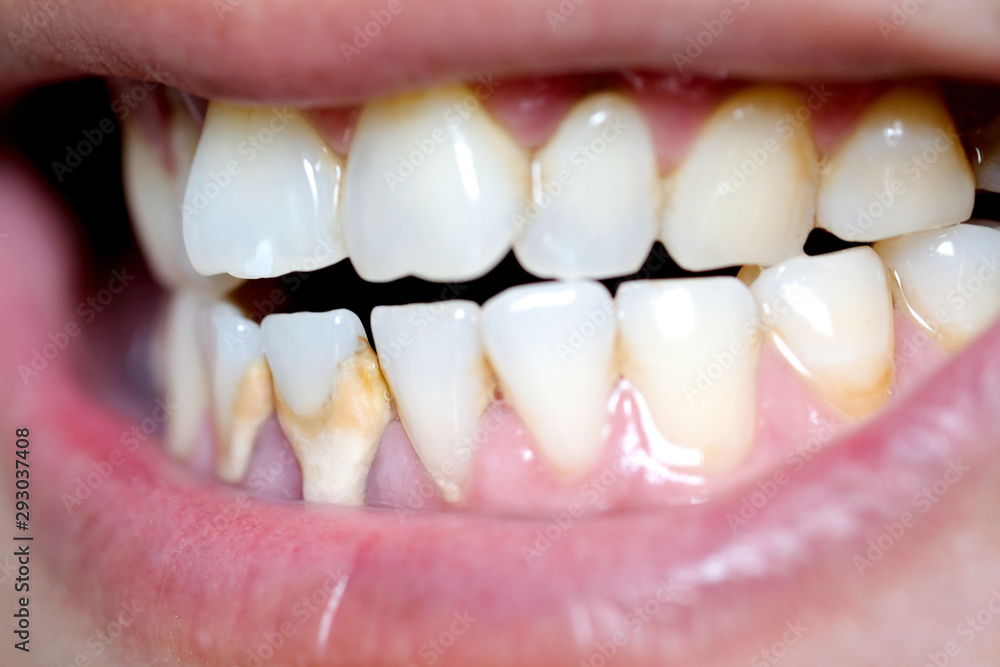 Tooth's a man smoking bad. Man smokes a cigarettes have tooth decay and ...